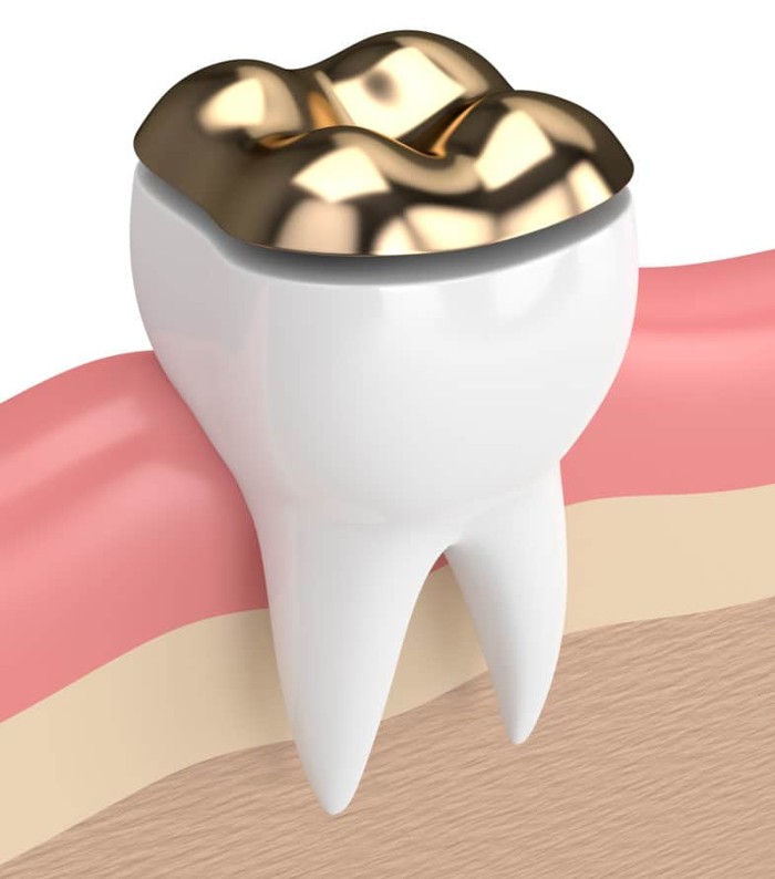 Inlays & Onlays - Mint Dental