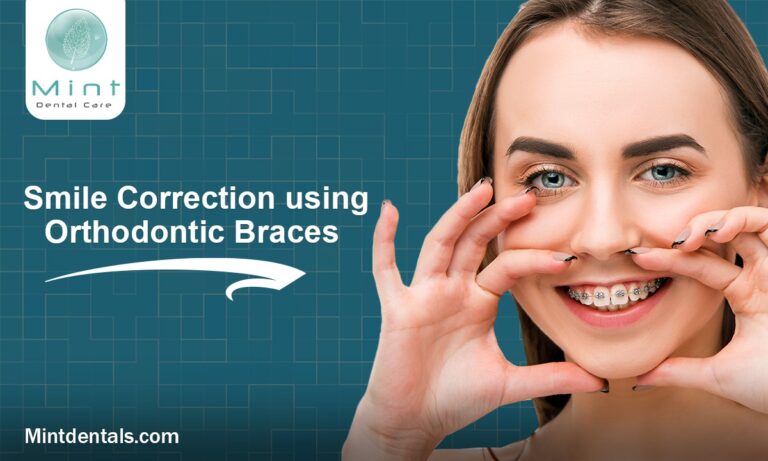 Smile Correction using Orthodontic Braces - Mint Dentals Care