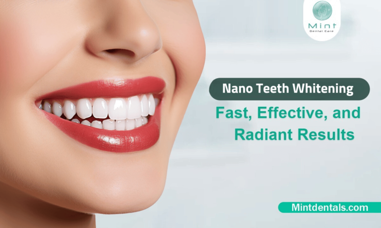 Nano Teeth Whitening vs. Traditional Teeth Whitening - Mint Dentals Care
