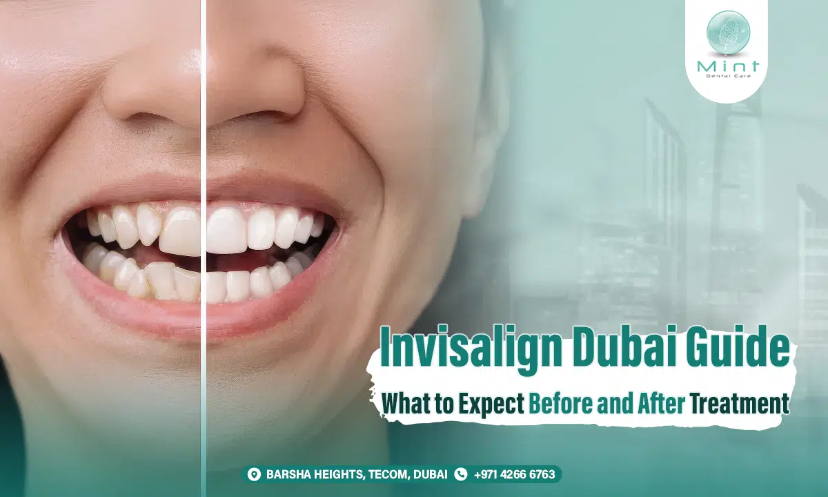 Invisalign Dubai Guide: What to Expect Before and After Treatment ...